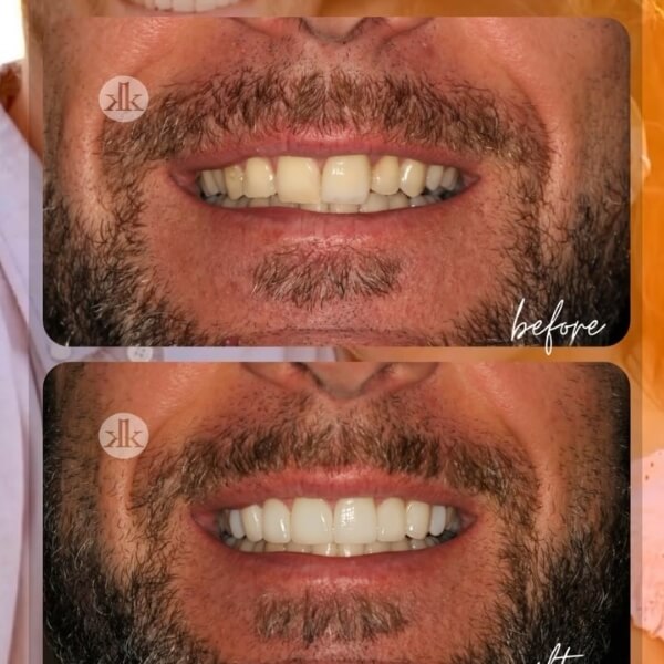 What Are the Differences Between Scaling and Root Planing, Flap Surgery ... What Are the Differences Between Scaling and Root Planing, Flap Surgery ...